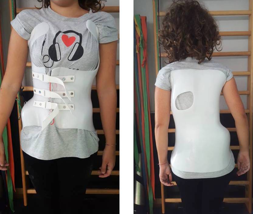 Despre corsetul Cheneau :: Corset scolioza / scoliosis braces