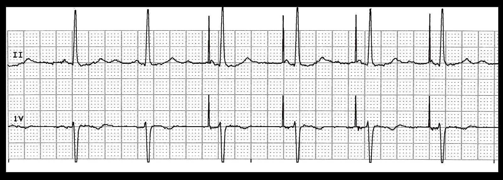 Basic EKG Rhythm Test 43