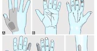 Autonomous Sensory Zones of Peripheral Nerves