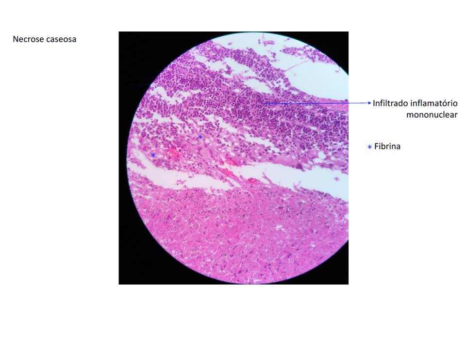 HISTOLOGIA90: TIPOS DE NECROSE