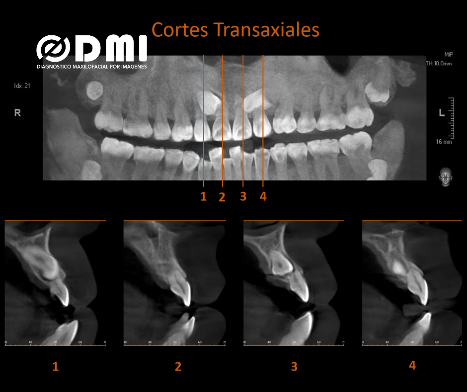 Diagnóstico Maxilofacial por Imágenes: Caso 06 _ Reabsorción radicular ...