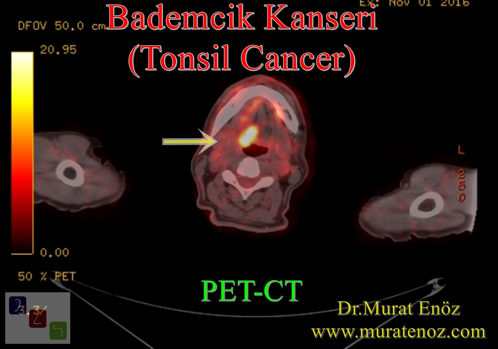 Tonsil Cancer - Causes, Symptoms, Diagnosis and Treatment