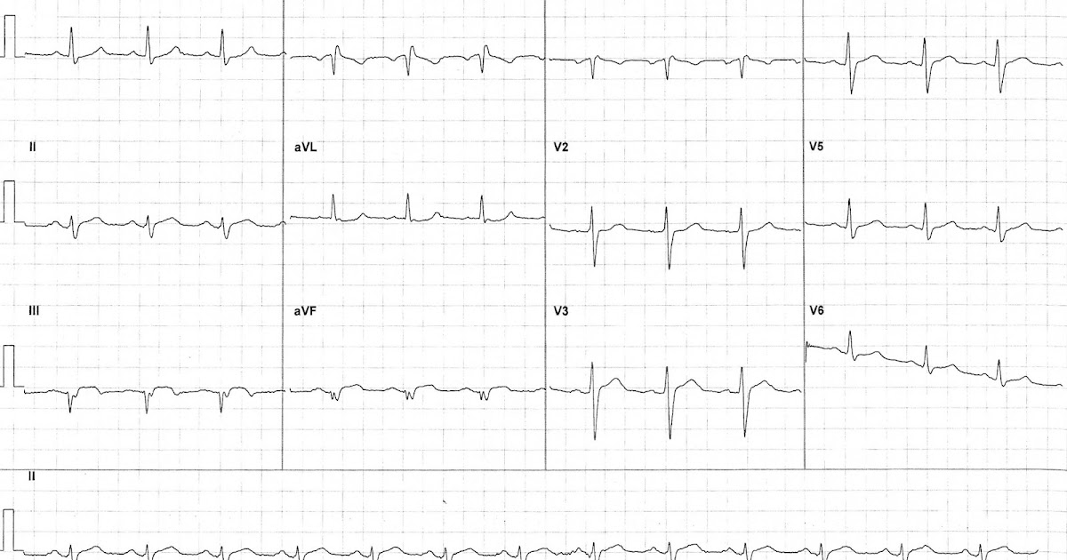 ECG of the Week: ECG of the Week - 28th March 2016 - Interpretation