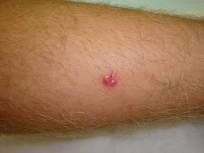 Dermpath Made Simple - Neoplastic: Spitz Nevus and Reed Nevus