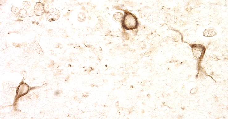 NeuroAnatomía Dr. William Ganem: La Degeneración cortico basal (DCB) o ...