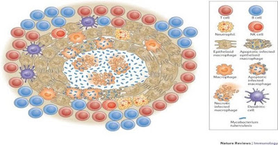 Figure 1 : A classical tuberculosis granuloma. The hallmark tuberculosis