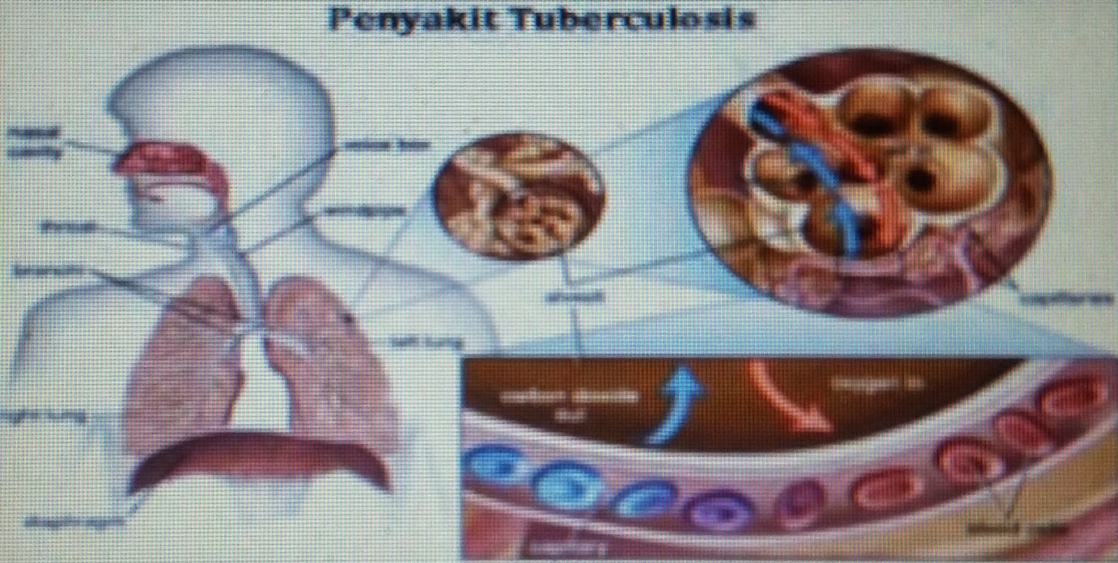 ogasa10.blogspot.com: PENYAKIT TBC (TUBERCULOSIS)