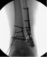 Case of the Month: Fracture cases at Harborview Medical Center ...