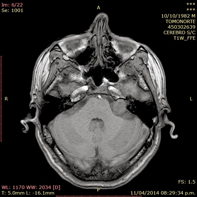 RADIOLOGIA RMC-KODA: Neurinoma del acustico