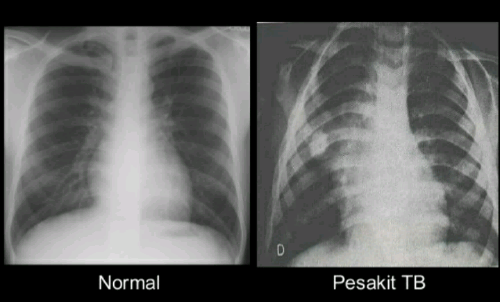 Rawatan Alternatif Penyakit Tibi