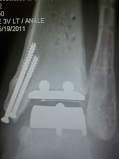 My Total Ankle Replacement: Post-op Photos - GRAPHIC!