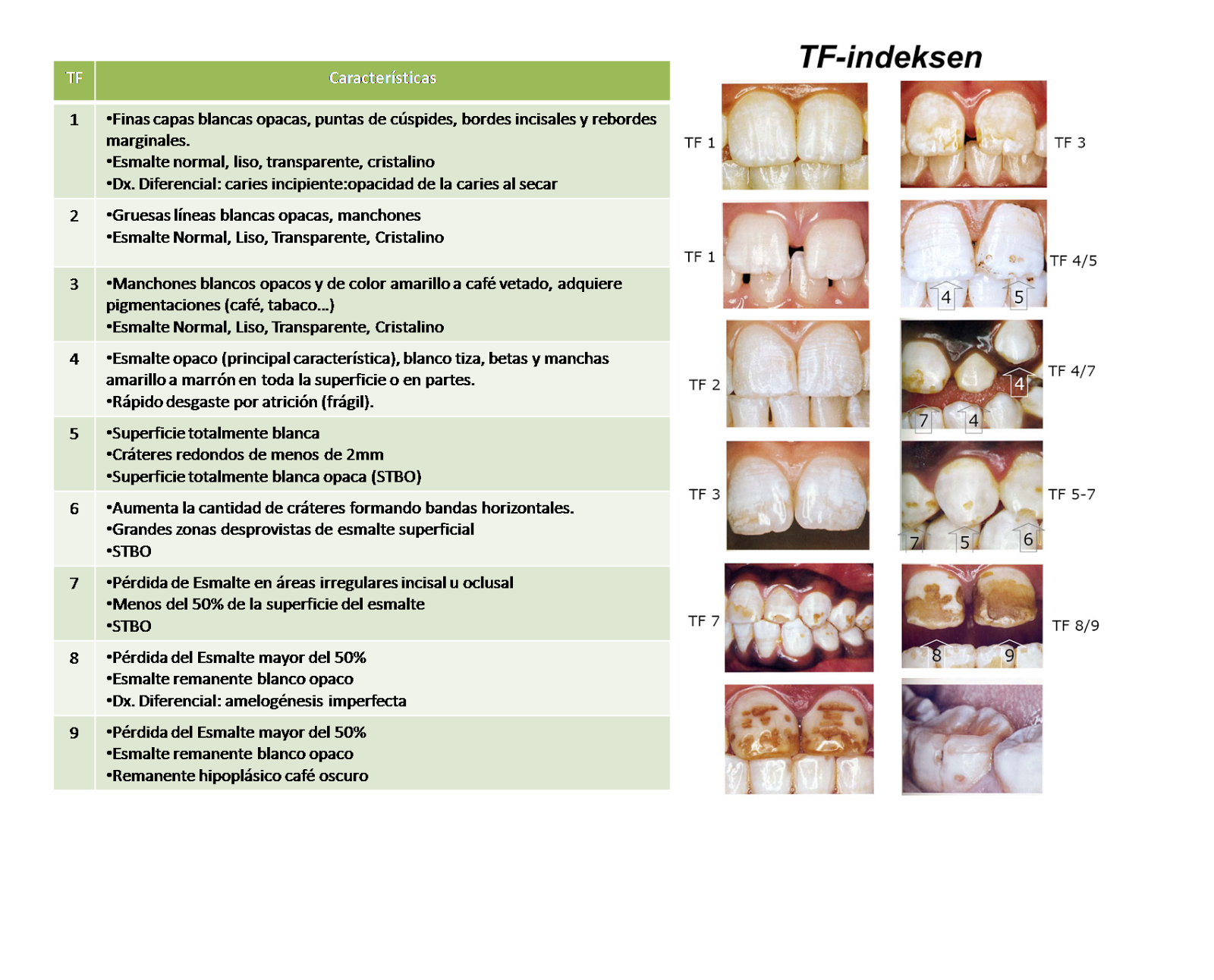 Apuntes De Odontolog a Fluorosis Dental apuntes-de-odontolog-a-fluorosis-dental