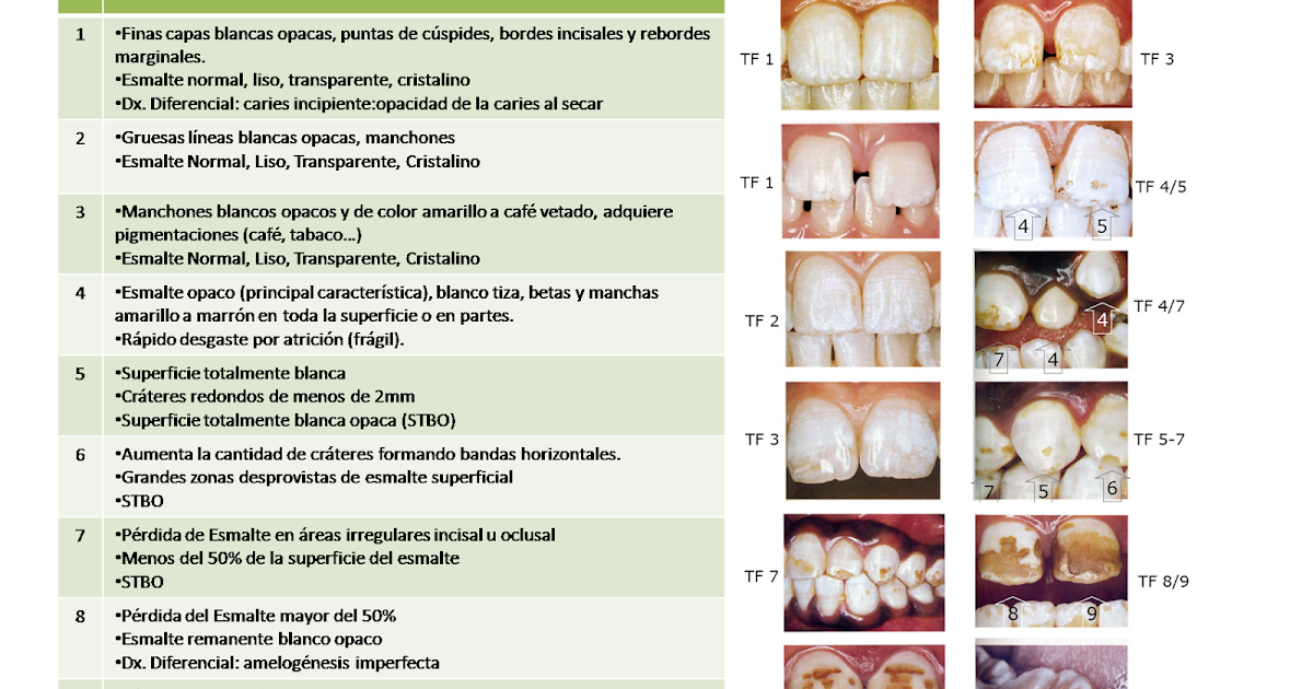Apuntes De Odontolog a Fluorosis Dental Apuntes De Odontolog a Fluorosis Dental