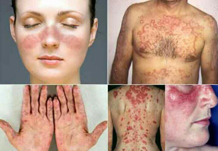 Penyakit Sle - Perumperindo.co.id