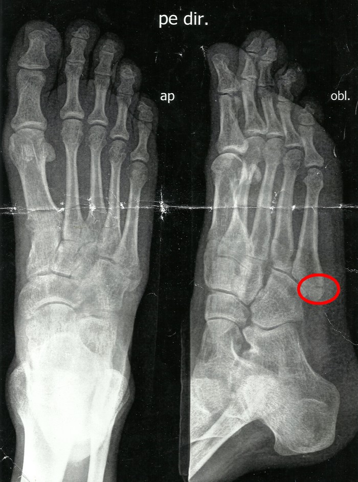 Iba Mendes: Fratura do 5º metatarso