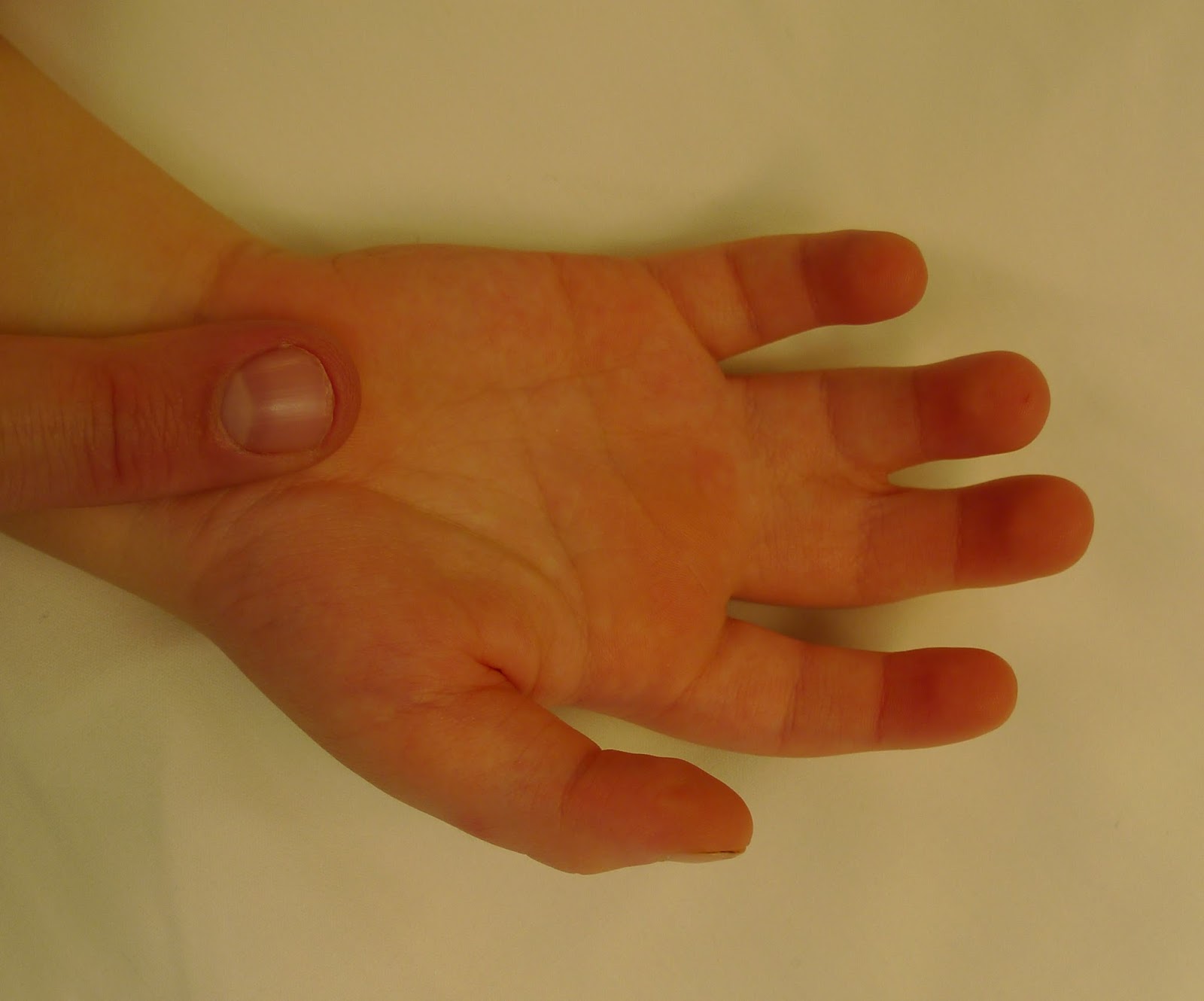 Partial Syndactyly | Congenital Hand and Arm Differences | Washington ...