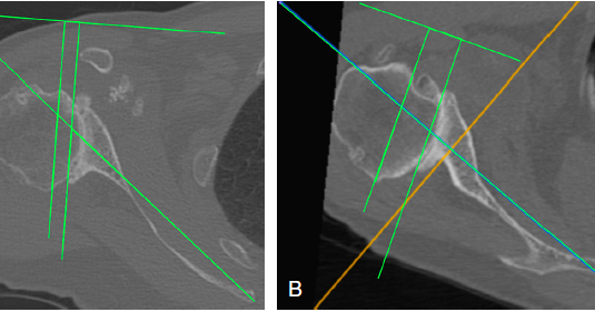 Shoulder Arthritis / Joint Replacement : The arthritic glenoid ...