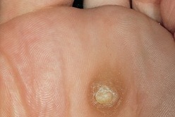 Symptoms of Clavus, traits, and treatment - HealthAllSide