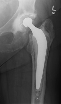 ASEPTIC LOOSENING OF THR - DNB Orthopaedics MS Orthopedics MRCS Exam ...