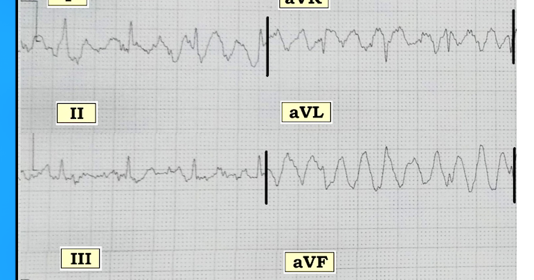 ECG Interpretation: ECG Blog #148 (Ventricular Fibrillation - VFib ...