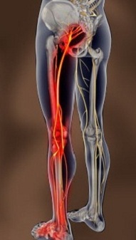 FLEX PHYSIOTHERAPY: Apa Itu Sciatica?