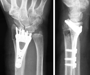 SMITH’s FRACTURE