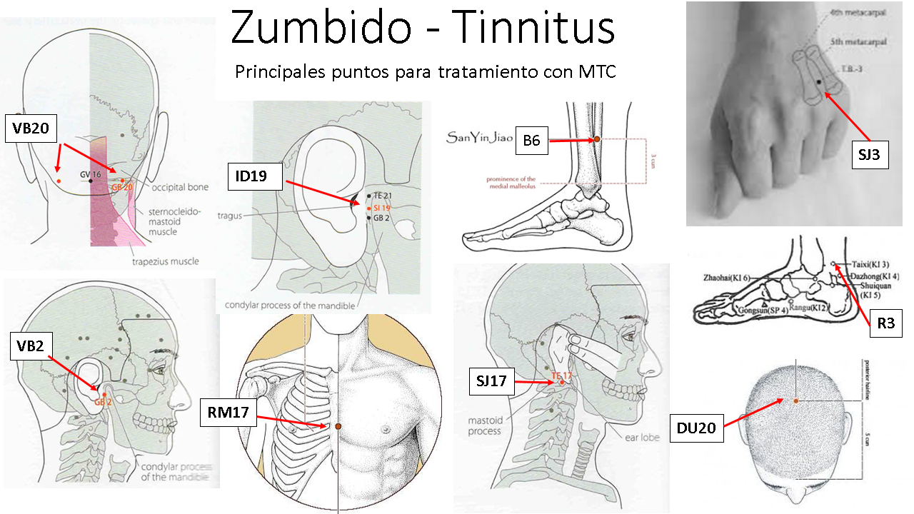 Tinitus – Zumbido de oídos. Tratamiento con acupuntura y MTC