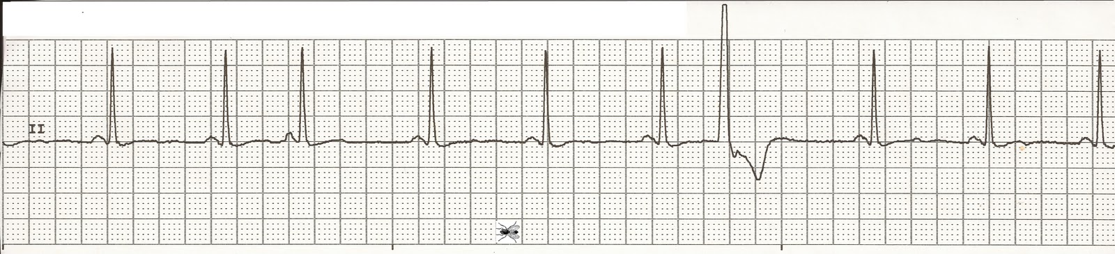 EKG Rhythm Strips 24: Ectopic beats