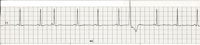 EKG Rhythm Strips 24: Ectopic beats