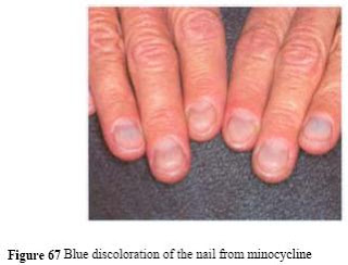Nail Diseases: Blue Nails