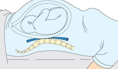 Moms New Baby: Are You At Risk For Supine Hypotensive Syndrome?