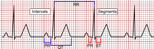 Diario de un afectado por ictus: Tromboembolismo pulmonar TEP