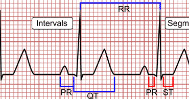 Diario de un afectado por ictus: Tromboembolismo pulmonar TEP
