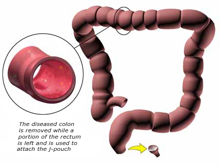 Do you want a potato?: J-Pouch : One year later
