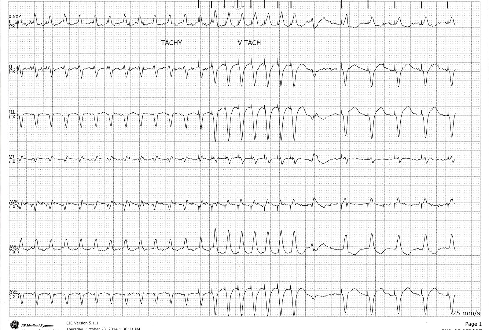 Overdrive pacing