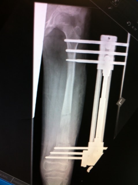 Amaya's Journey with PFFD: Done lengthening!!!!!