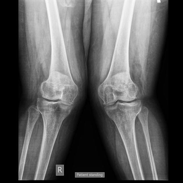 Korektivna gimnastika: X noge