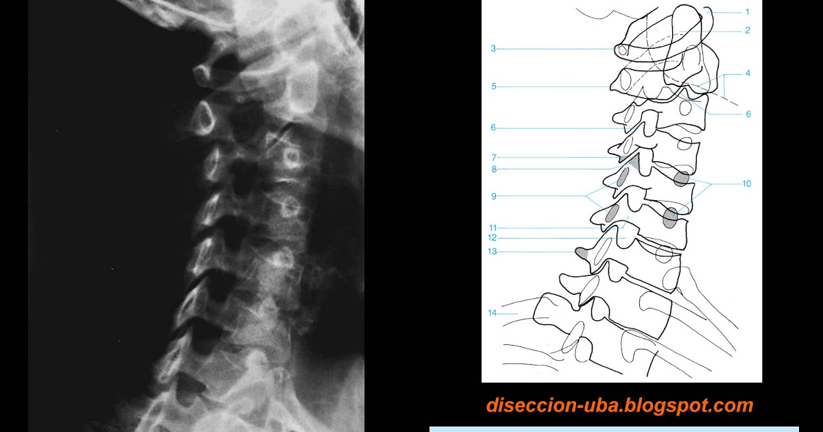 rx: Rx columna cervical oblicua