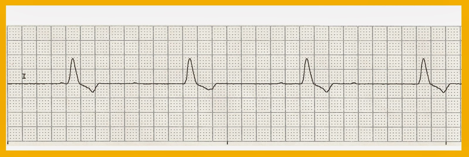 Practice EKG Rhythm Strips 214