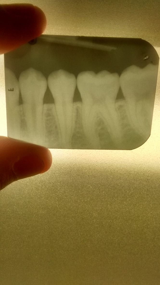 Radiologia 2016: Rx premolares y molares inferiores