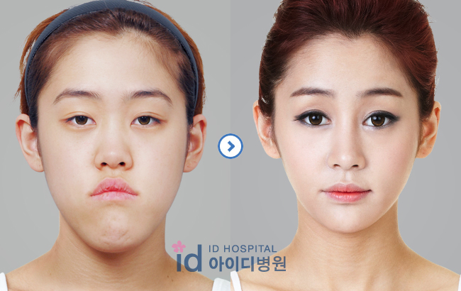 ID Hospital Korea: it is miracle! two jaw/double jaw surgery, v-line ...