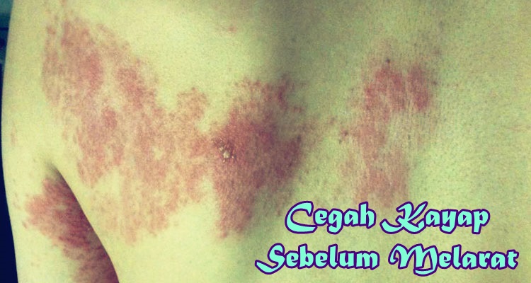 Tanda-Tanda Kayap dan Cara Merawat Kayap Dengan Berkesan - Pengedar ...