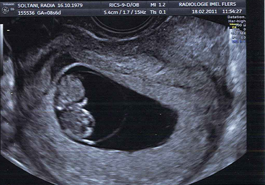 Elissa: Echographie précauce 18 fev 2011 (8 SA + 5 J)
