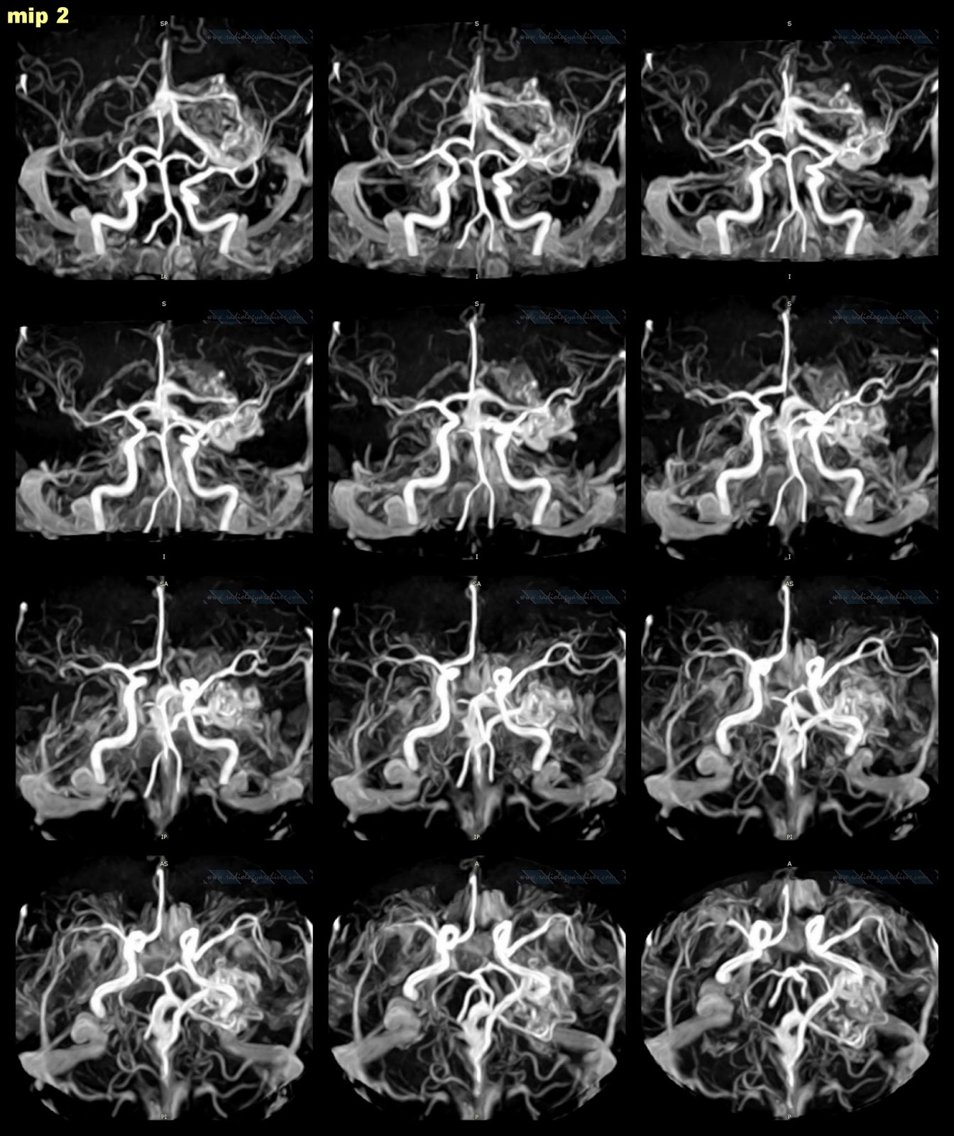 Radiology Archives: Αρτηριοφλεβώδης Δυσπλασία Εγκεφάλου (Spetzler ...