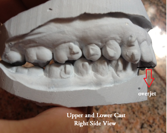 My Journey to LIFE. (previously My Invisalign Diaries): Maths on my ...