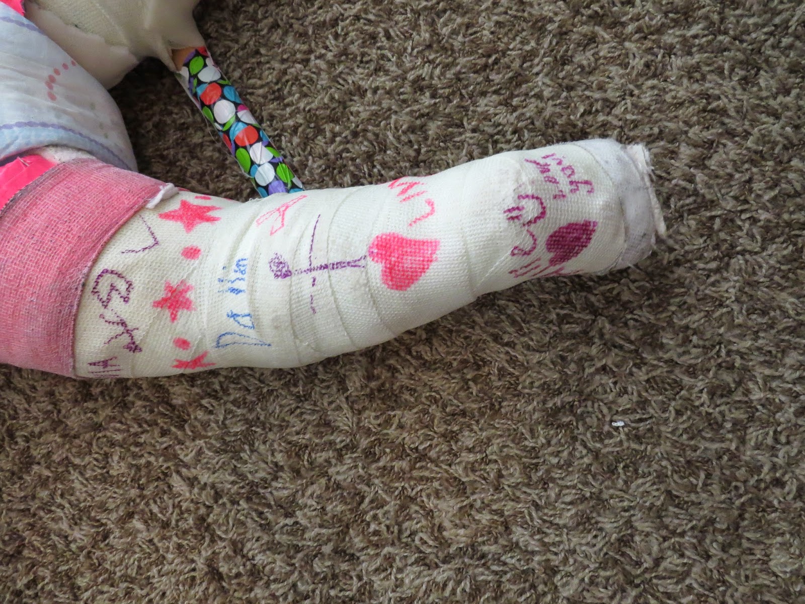 Caring for the Hip Spica Cast : Coping.