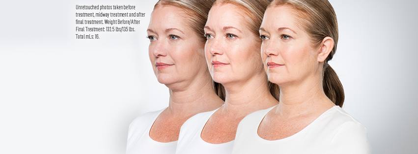 Sei Bella Med Spa: Kybella...for Submental Fat (aka...double chin)