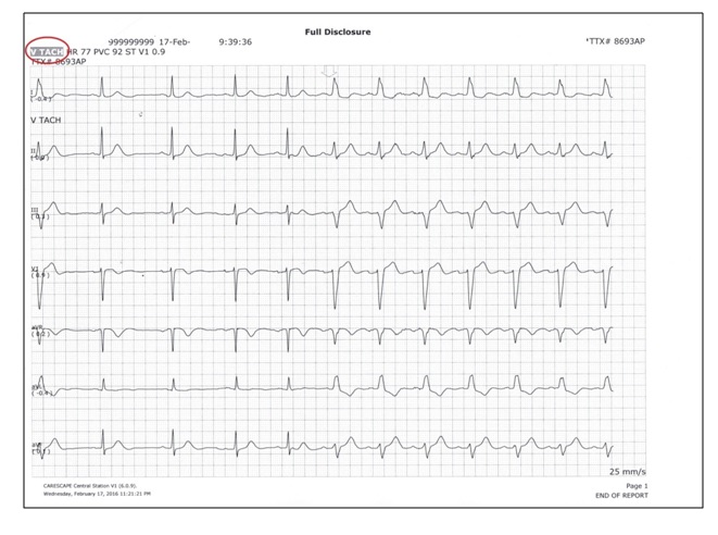 ECG Rhythms: Aberrancy