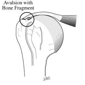UW Shoulder and Elbow Academy: Rotator Cuff 3 - Patterns of tearing