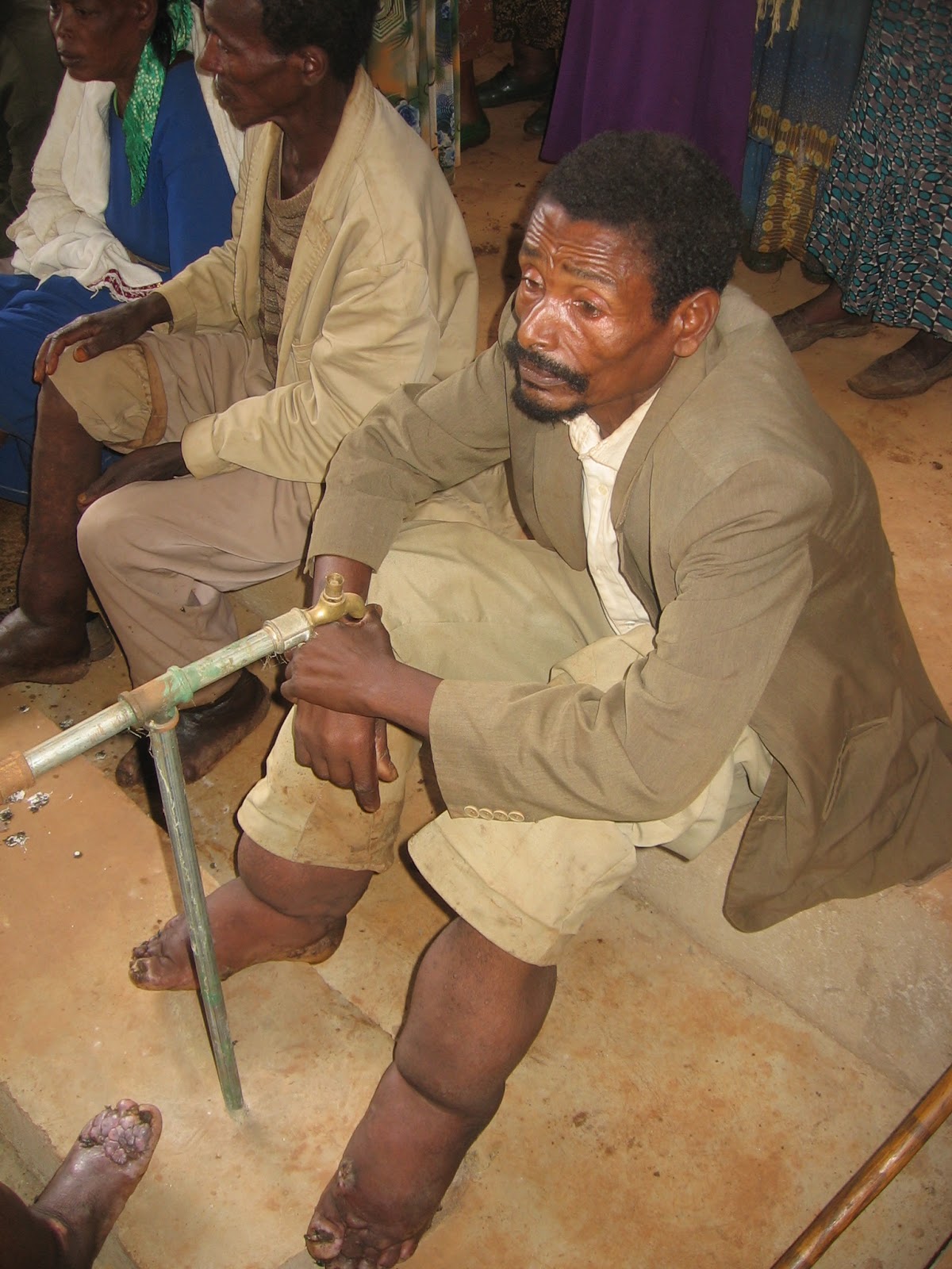 Enhancing Eyesight in Ethiopia: Mossy Foot
